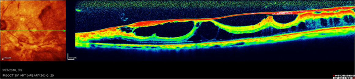 Epiretinal Membrane Treatment in New York - Retina Group